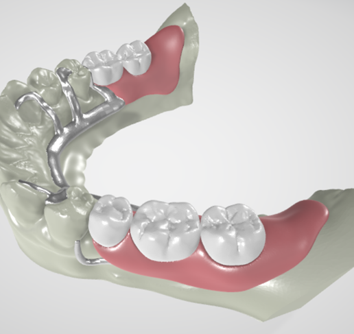 rpd denture lower