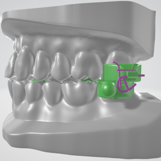 🦴 HIGH RESOLUTION MARA (Mandibular Anterior Repositioning Appliance ...
