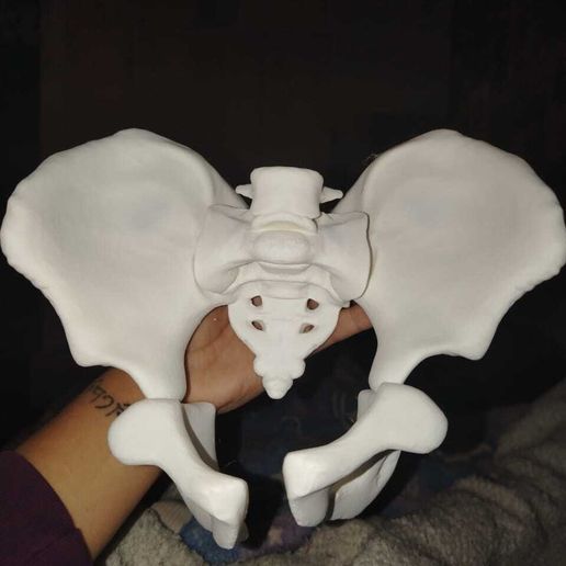🫀 Pelvis with dysplasia - Realistic 3D anatomical model (educational ...