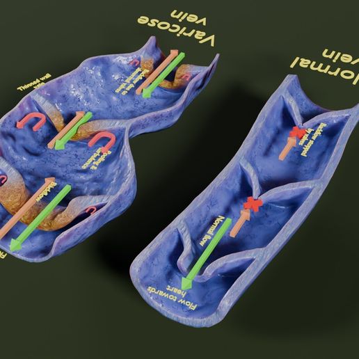 ⚕️ Varicose vein valve・ STL File for 3D printing・Cults