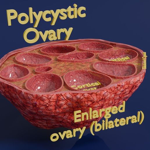 ⚕️ Polycystic Ovary Disease PCOD・ STL File for 3D printing・Cults