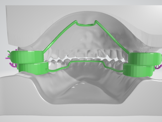 🦴 HIGH RESOLUTION MARA (Mandibular Anterior Repositioning Appliance ...