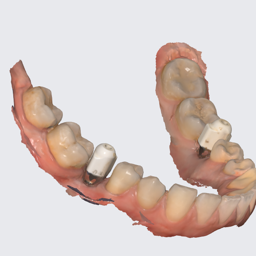 🩻 Intraoral Scan dental practice case・ STL File for 3D printing・Cults