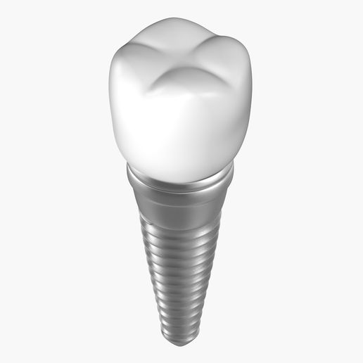 ⚕️ Dental Implant 3D Model – Medical Implantology Study Model ...