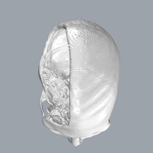 💀 Large traumatic skull from DICOM and prosthetic solution・ STL File ...