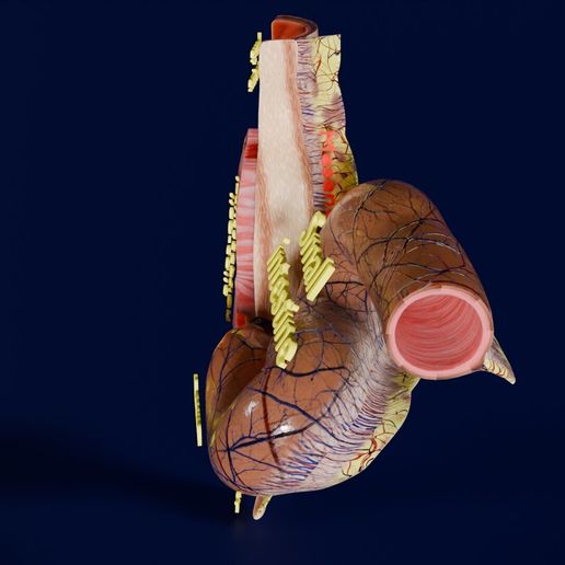 ⚕️ Intussusception intestine ileocolic obstruction・ STL File for 3D ...