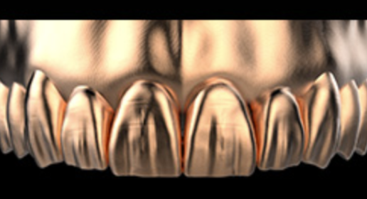 👑 The complete set of 36 'Expression' dental libraries - Exocad・ STL ...