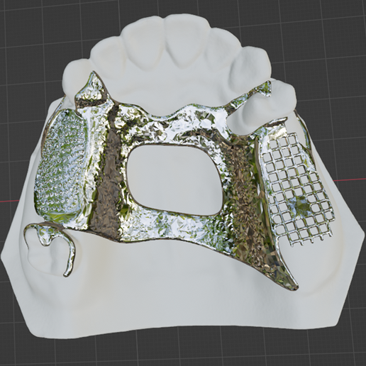 🦷 Prosthodontics Kennedy Class II Mod 1 Removable Partial Dentures ...