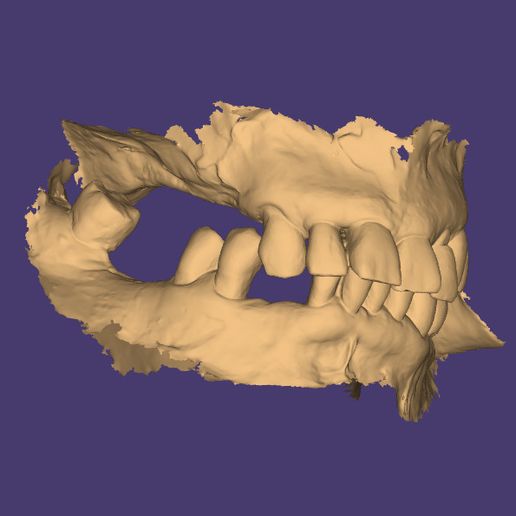 🧑‍🏫 INTRAORAL SCANS FOR RPD/FLIPPER - REAL PATIENTS, STUDY SCANS ...