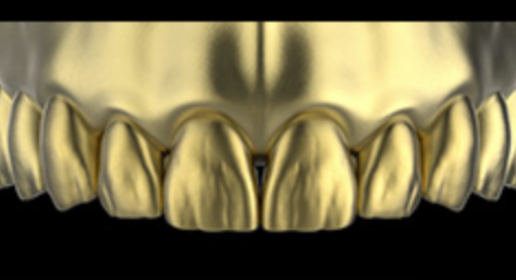 👑 The complete set of 36 'Expression' dental libraries - Exocad・ STL ...