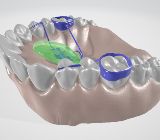 🦷 3 PARTS PENDEX DISTALIZER ON UPPER TEETH DENTAL APPLIANCE・ STL File ...