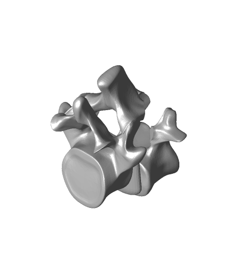 👽 Spondy grade 2 listhesis bennett model.stl・Free 3D File for ・Cults