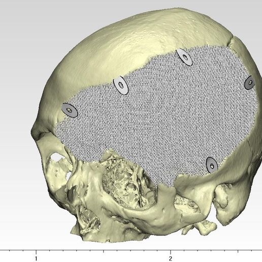💊 Cranial plate made according to anthropometric data (an interesting ...