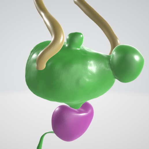 ♂️ 6 PARTS 3D Benign prostatic hyperplasia with complications ...