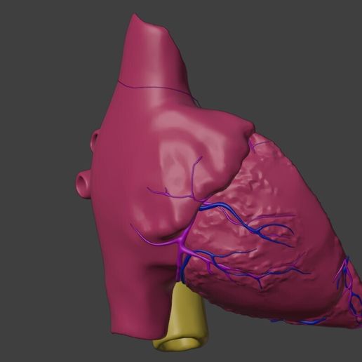 💜 3D Model of Heart with Atrioventricular Septal Defect - PSLAX・ STL ...