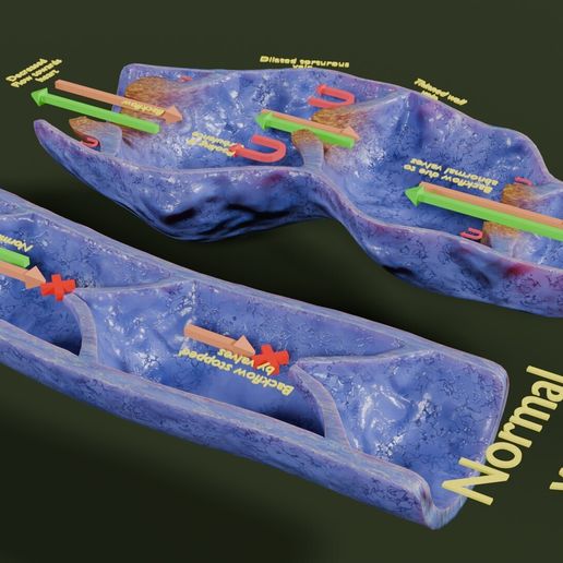⚕️ Varicose vein valve・ STL File for 3D printing・Cults