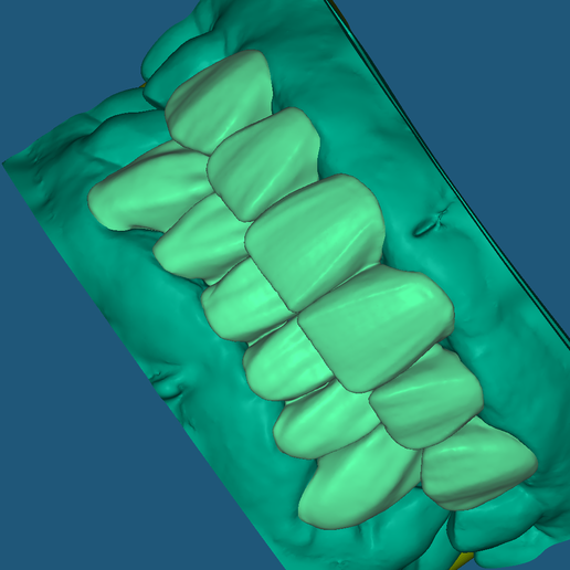 STL file exocad dental lab 🥼 ・3D print object to download・Cults