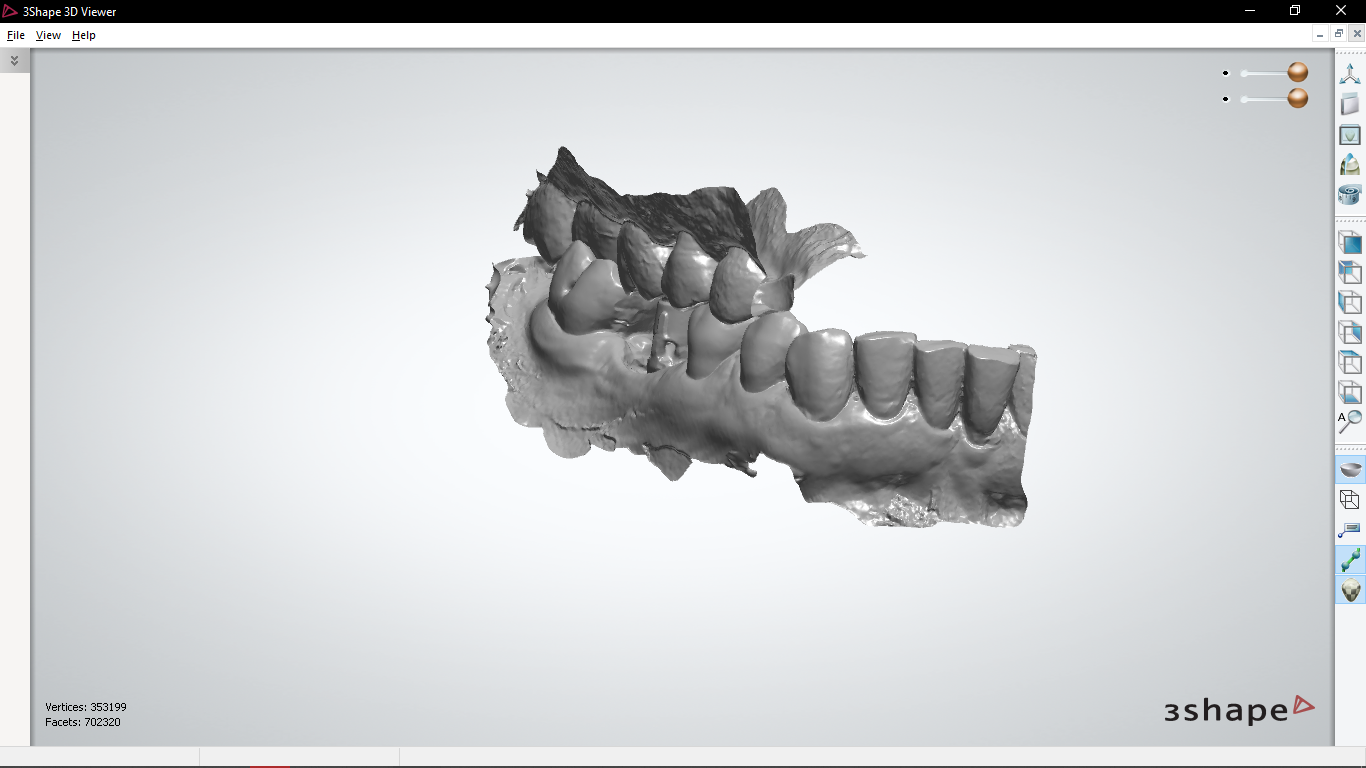 Free STL file Implant study models・3D print design to download・Cults