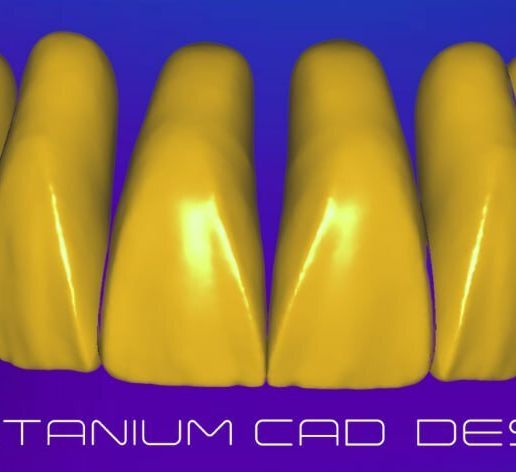 STL file exocad library titanium 🧞‍♂️ ・3D printing template to download ...