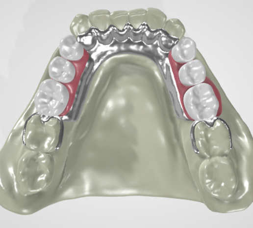 removable partial dentures part 1